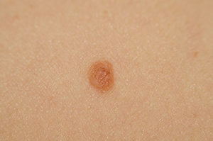 Mole Checkups & Treatments Near Me Arlington, VA | DC, McLean