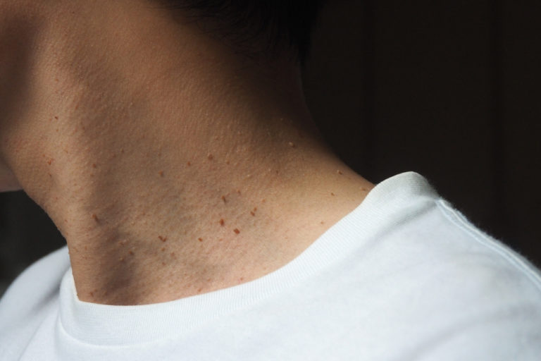 When Should I See A Dermatologist for Benign Skin Growths? - Arlington ...
