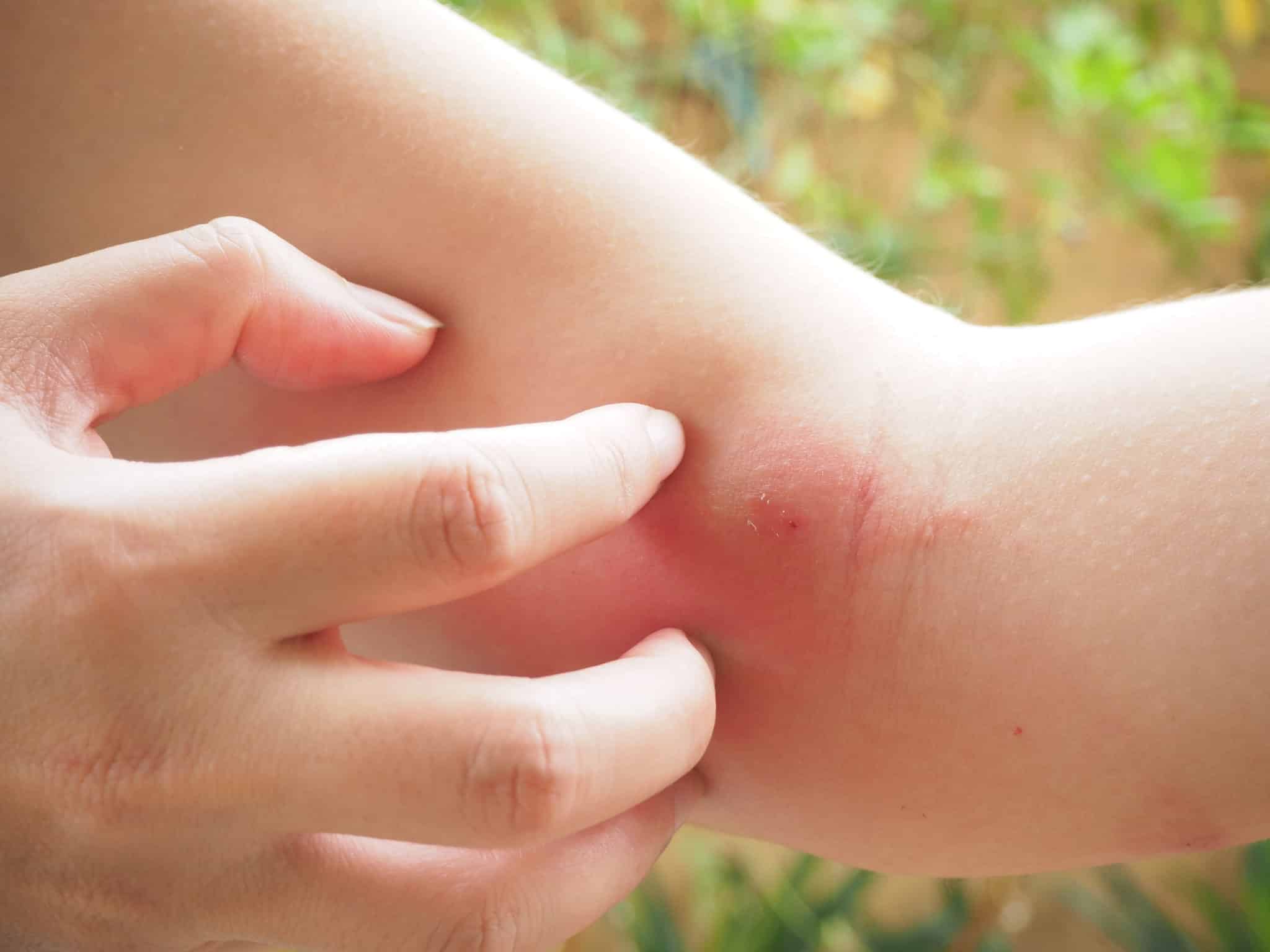Common Bug Bites & What To Do About Them - Arlington Dermatology Common Bug Bites & What To Do About Them - Arlington Dermatology