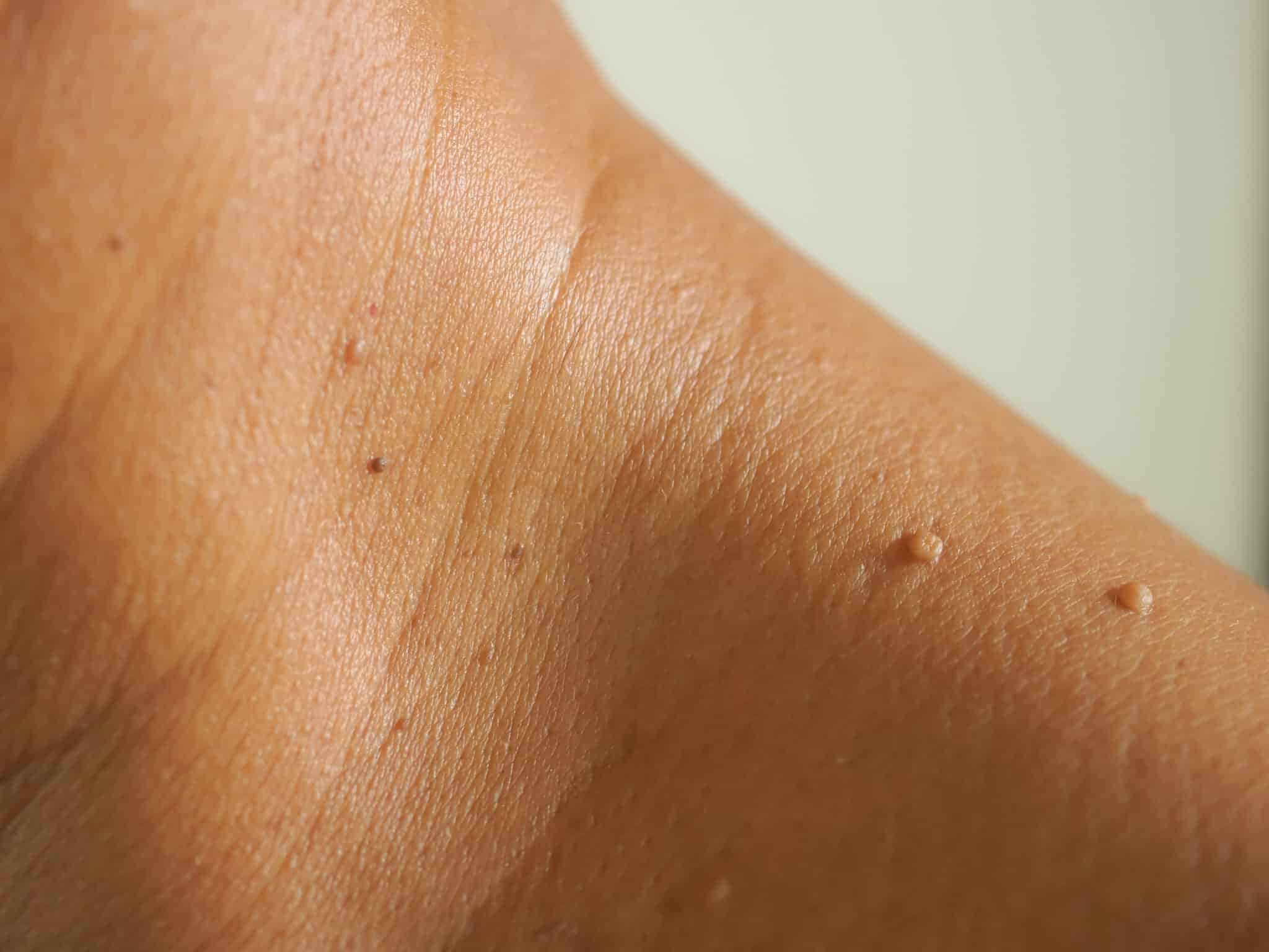 What Can I Do to Help My Skin Tags? - Arlington Dermatology