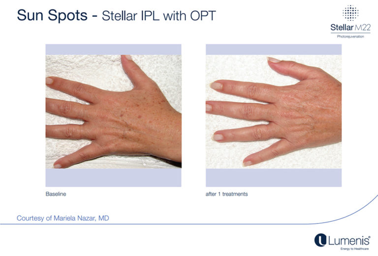 IPL Laser Resurfacing Near Me Arlington, VA | DC, McLean