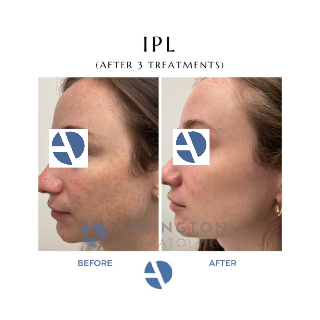 IPL Laser Resurfacing Near Me Arlington, VA | DC, McLean