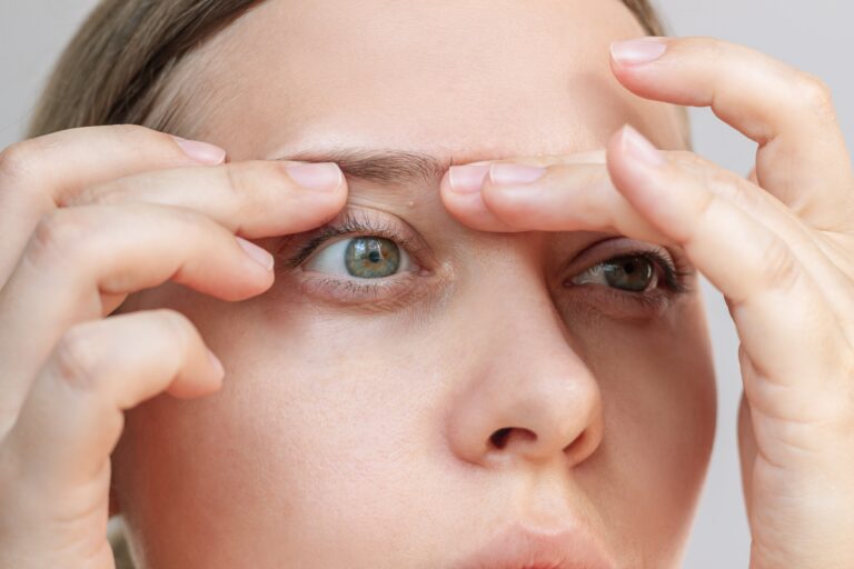 How to Get Rid of Milia - Arlington Dermatology